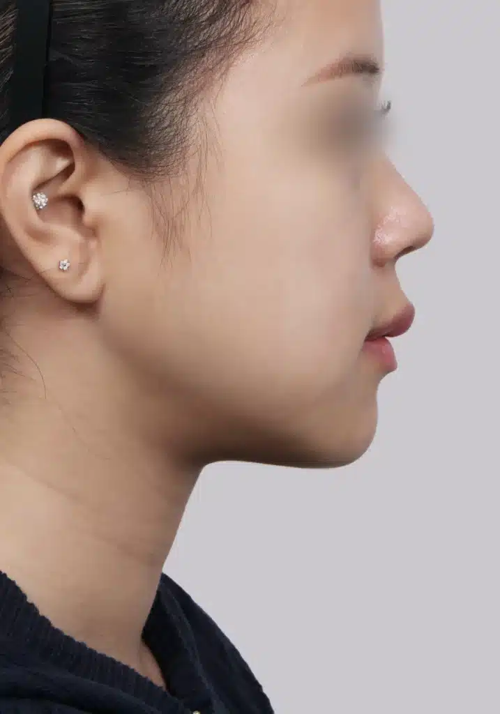 โรงพยาบาลศัลยกรรม | mini neck lift 숨어있는 턱선을 찾아드려요! 턱 리프팅!